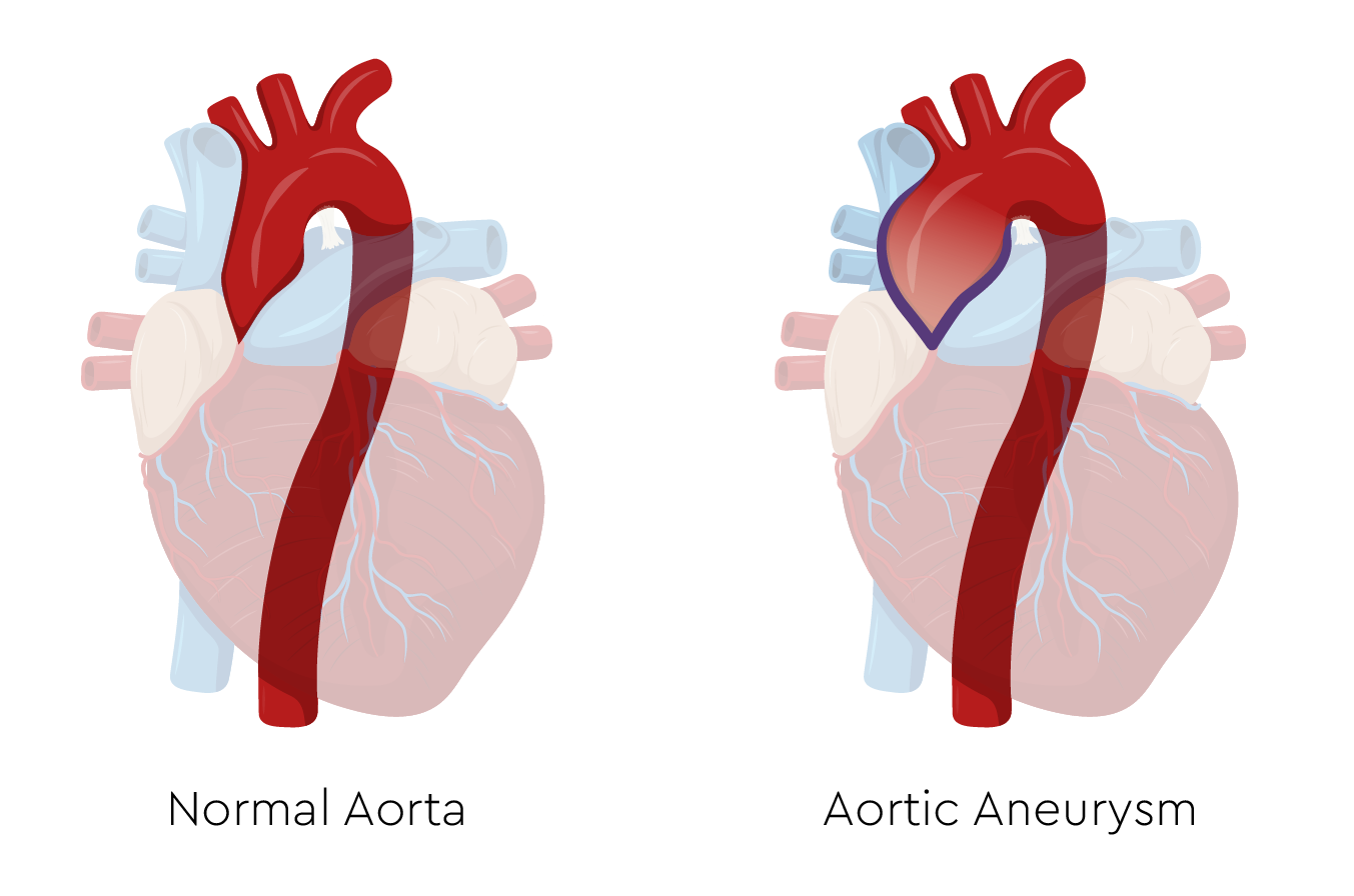 Aorta Basics | John Ritter Foundation