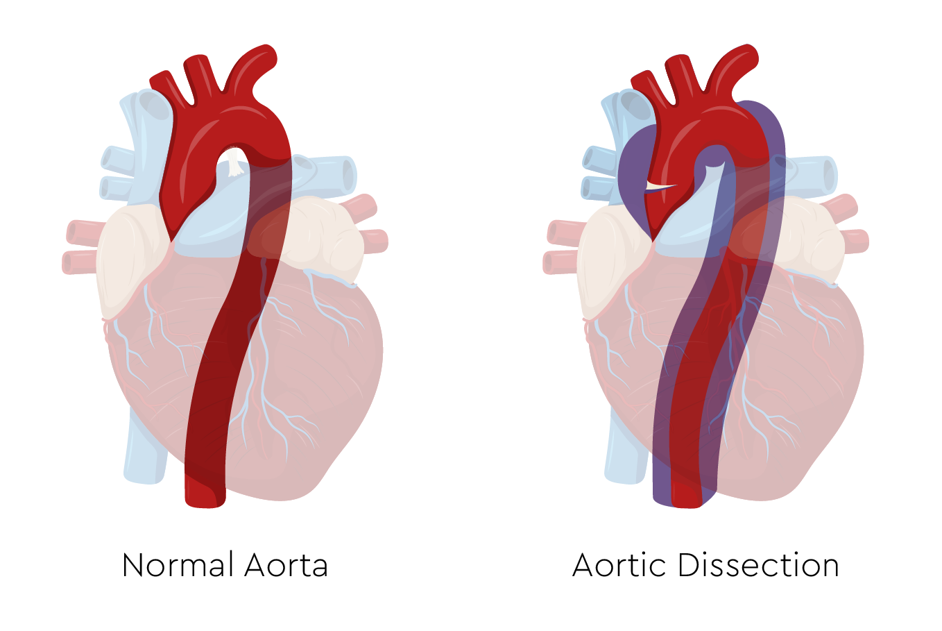 Aorta Basics | John Ritter Foundation