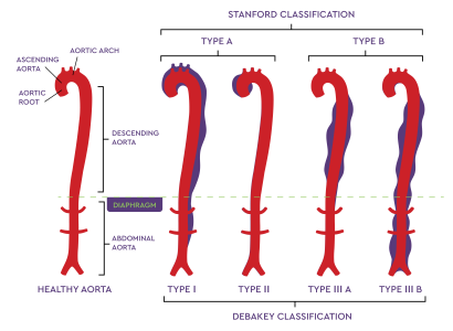 Aorta Basics | John Ritter Foundation